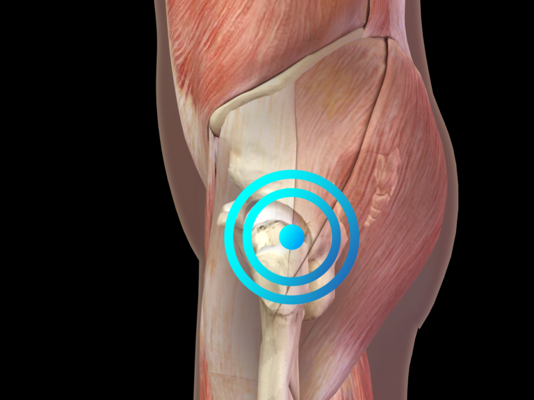 Shockwave Therapy for Hip Pain - MJ Physiotherapy